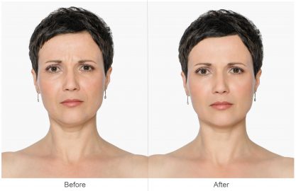 Botulinum Toxin (Botox) | ME Aesthetic Clinic Malaysia